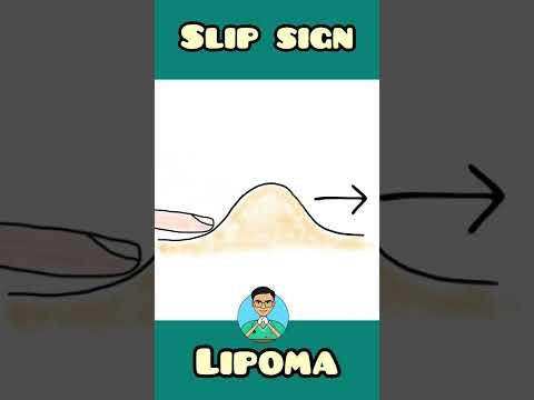 Slip sign in Lipoma | Surgery | #shorts