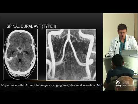 Spinal Vascular Malformations - Stephen Monteith, MD