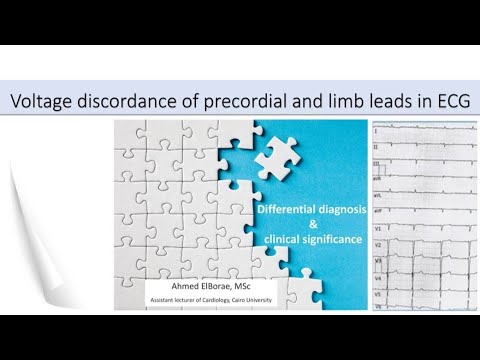 Voltage discordance in ECG