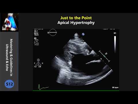 Apical Hypertrophy