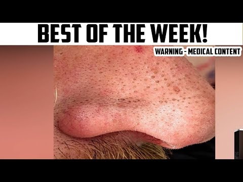 Mr. Blackheads BIG Week in Review!