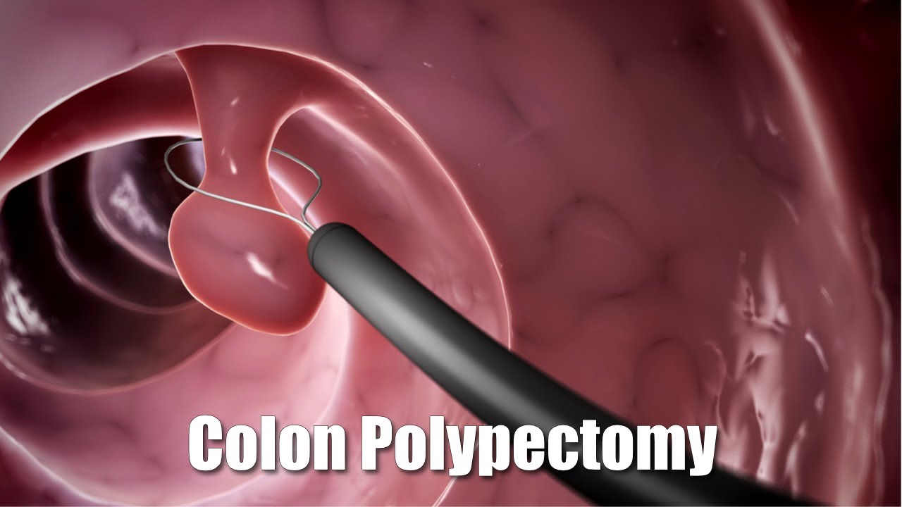 Removing a polyp from the colon (3D Animation)