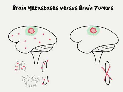 Doctor Explains Brain Metastases versus Brain Tumors
