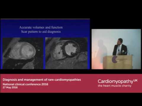 Rare causes of dilated cardiomyopathy and how to spot them