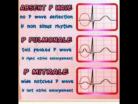 ecg finding of p wave