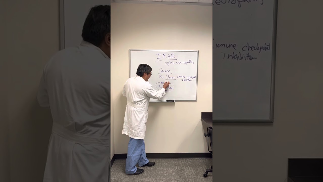 IRAE-optic neuropathy
