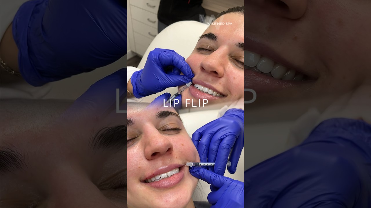 A little bit of Botox Lip Flip will make your upper lip look fuller - without lip injections