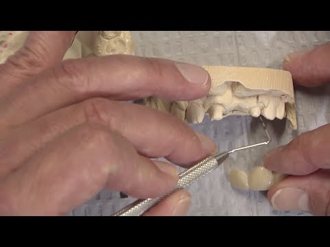 Case of the Week: Solutions for a Slippery BruxZir® Bridge
