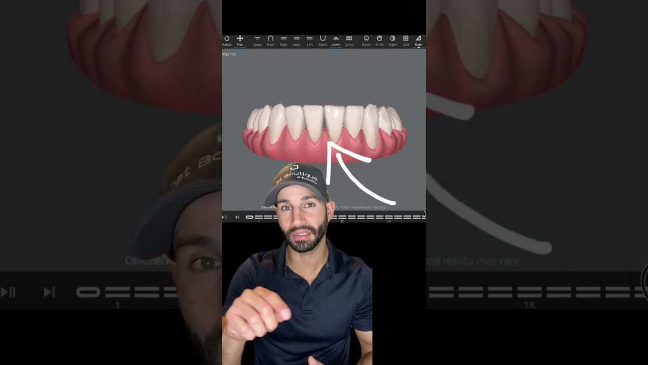 When we do IPR with Invisalign for overcrowding.