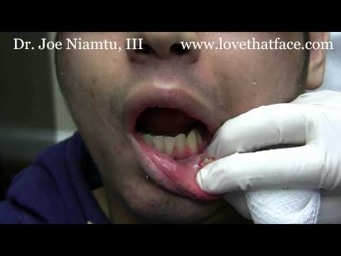 Lip Piercings Gone Bad « Dr. Niamtu’s Weblog
