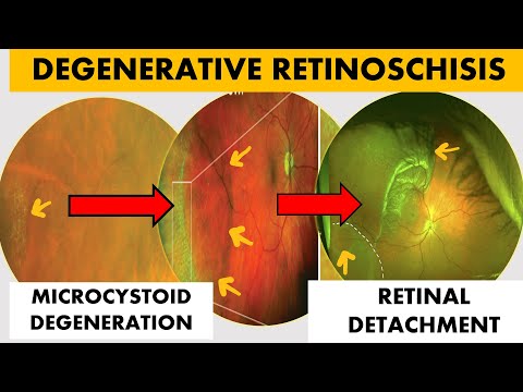 Degenerative Retinoschisis: A complete guide