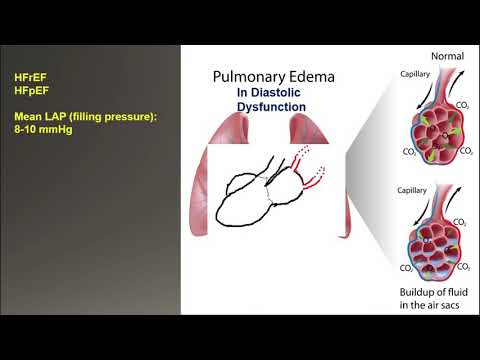 Diastolic Dysfunction II