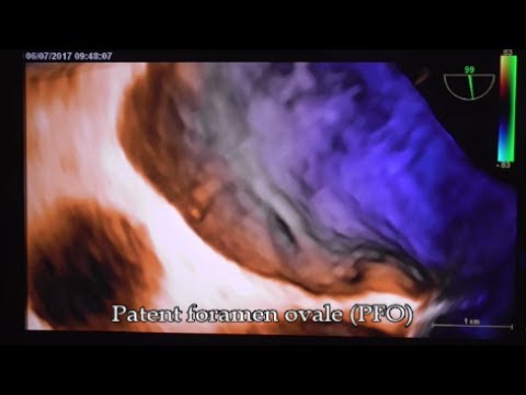 Patent foramen ovale (PFO)