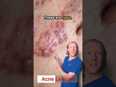Acne Lesions: White Heads, Black heads, Pustules, Papules, Cysts & Nodules