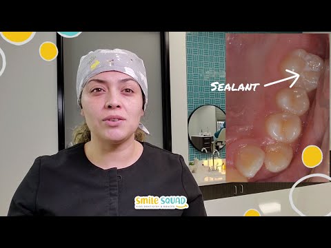 What is a Sealant? Answered by Dr. Alvarez