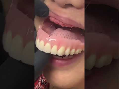 Comfortable denture!