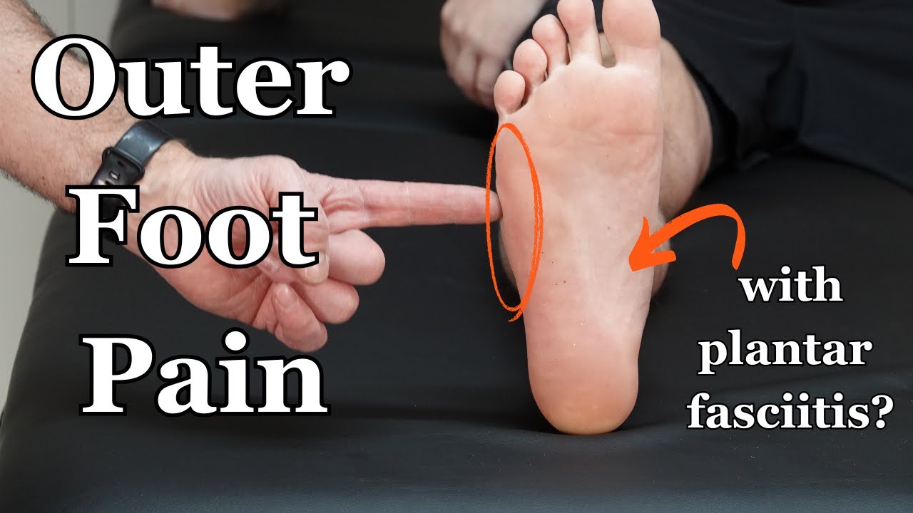 Outer Foot Pain and Plantar Fasciitis