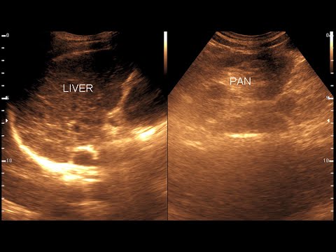 Wilsons disease | CLD | Splenomegaly