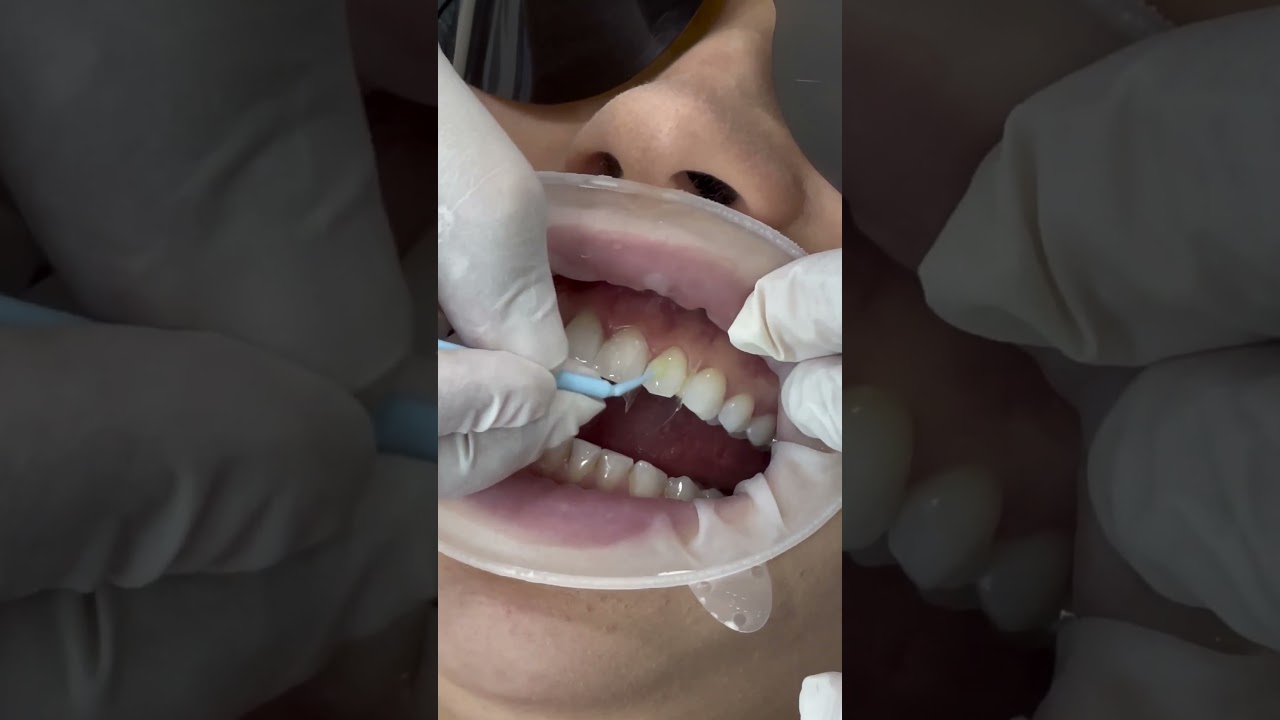 A Closer Look at Composite Bonding