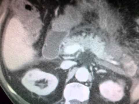 NECROTIC PANCREATITIS AND PERIPANCREATIC COLLETIONS AND ASSOCIATED ILEO ADINAMIC