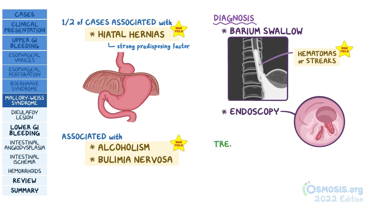 Gastrointestinal Bleeding |GI Surgery | Osmosis Pathology Review