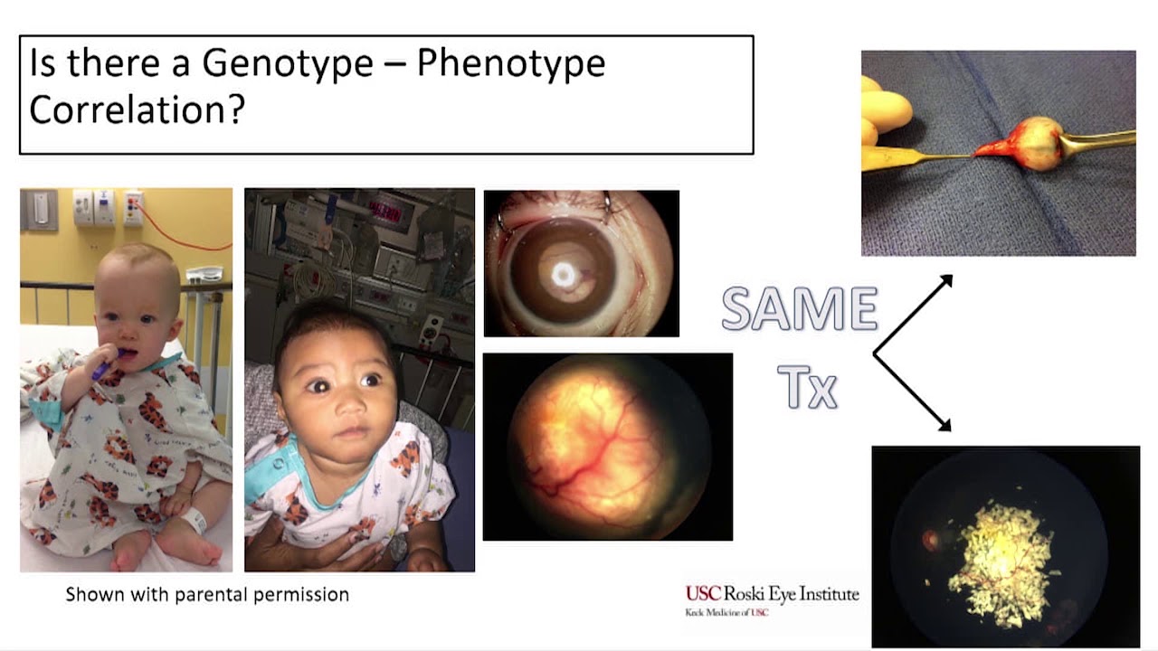 Aqueous Humor Genomics Predicts Eye Salvage in Retinoblastoma by Jesse Berry, MD