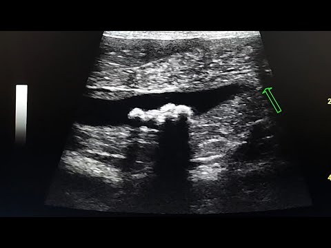 ultrasound case - multiple common bile duct stones