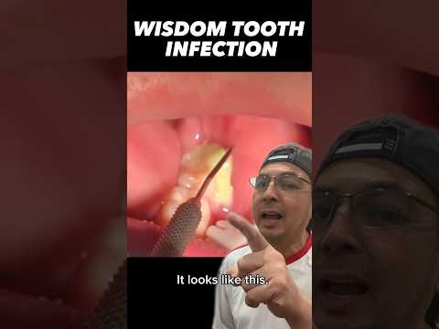 How to Treat a Wisdom Tooth Infection | In Office to Hands On Dental Training #shorts