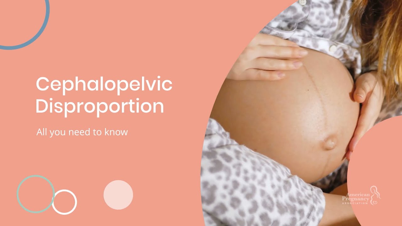 Understanding Cephalopelvic Disproportion