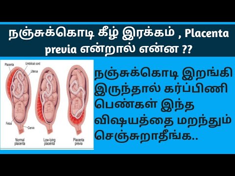 Low-lying placenta or Placenta previa during pregnancy in Tamil |Do's & Don't of low-lying placenta