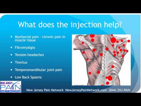 Overview of Trigger Point Injections Explained by a NJ Pain Clinic
