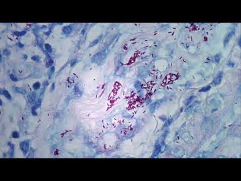 ZN Stain // Acid Fast Stain // Reporting // AFB // M. TB