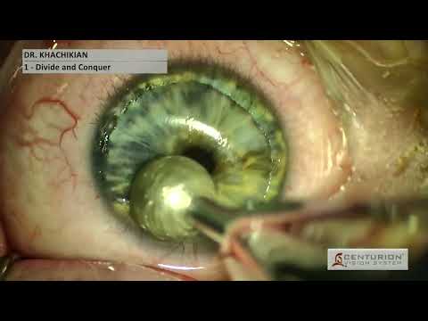 Epithelial/Anterior Basement Membrane Dystrophy (EBMD/ABMD) aka Cogans aka Map Dot Fingerprint