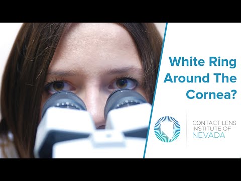 Corneal Arcus (White Ring Around Cornea) And What You Need To Know