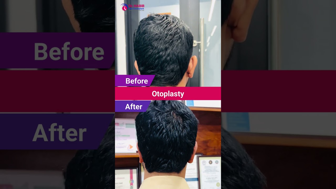 ✨ Otoplasty (Ear Reshaping) Before & After | Dr. Habib's Amazing Results! 🌟