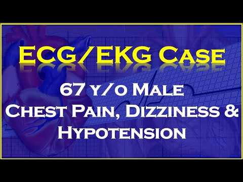 ECG/EKG Case Review: 67 y/o male with chest pain, diaphoresis, and hypotension.