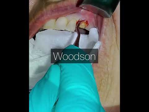 Canine Extraction Tip #dentalextractionvideo #drwahan