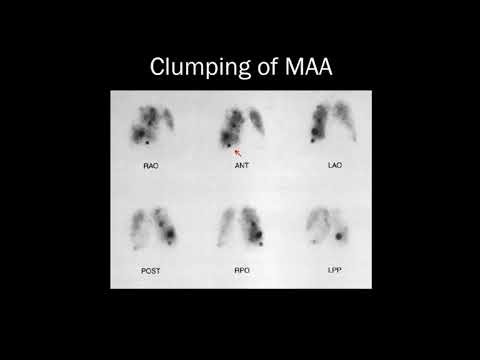 V/Q: Simplified Criteria for the On-Call Radiologist | 15 Minute Radiology CME