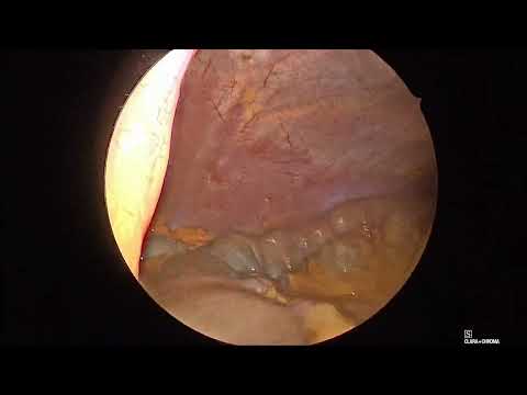 Laparoscopic Small Bowel Diverticulosis