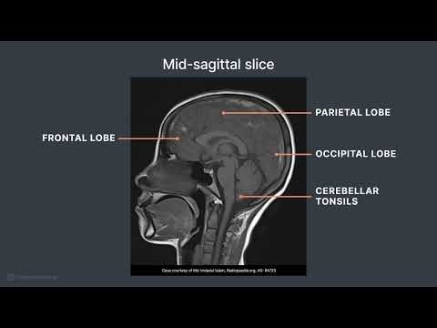 MRI Cross Sectional Anatomy of the Brain (Sagittal View)
