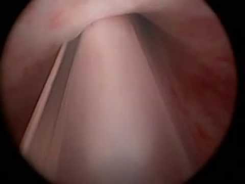 Urethral Stricture. All Rights Reserved by the Urology Group 2013.