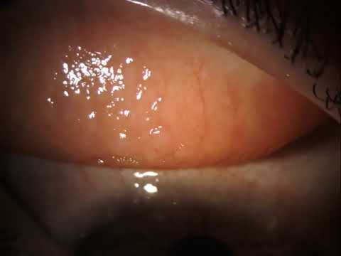 Cobblestone conjunctiva
