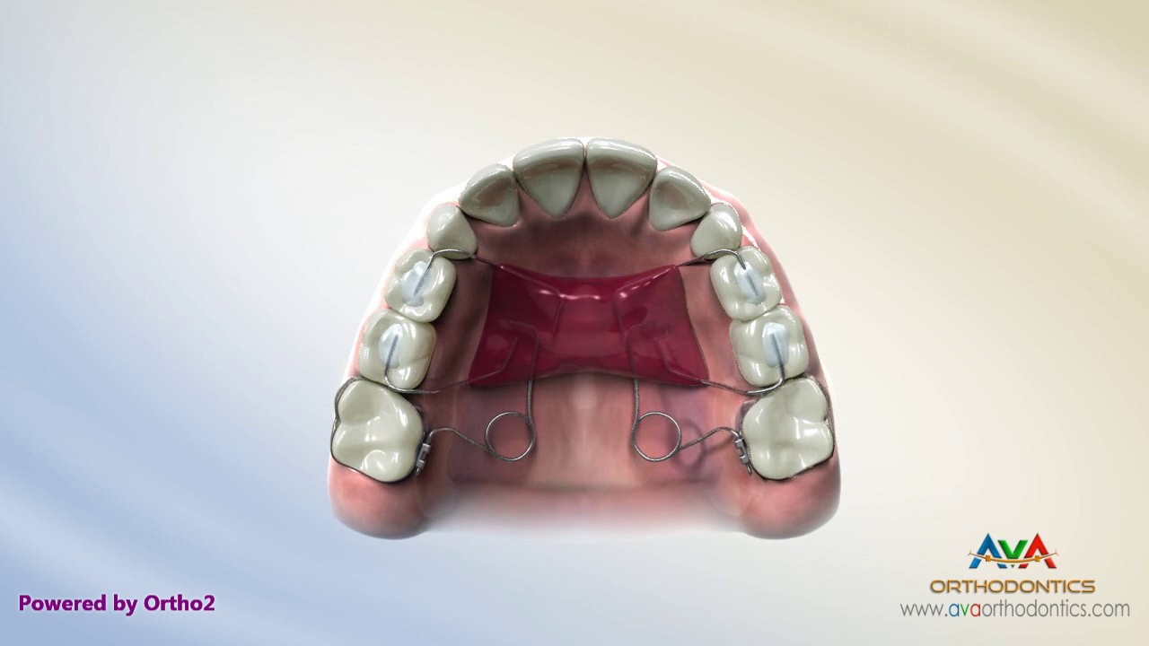Orthodontic Space Management - Pendulum Appliance
