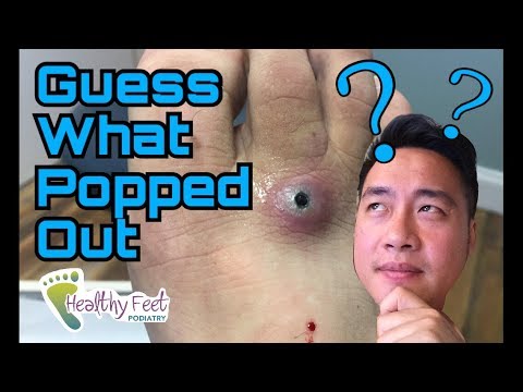 Guess What Popped Out of this Foot! By Podiatrist Dr. Binh Nguyen