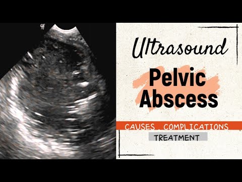 Ultrasound Tubo-Ovarian Abscess - Life Threatening Infection | Infertility