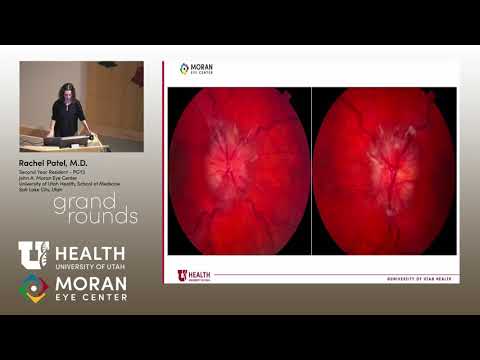 Peculiar Pediatric Papilledema