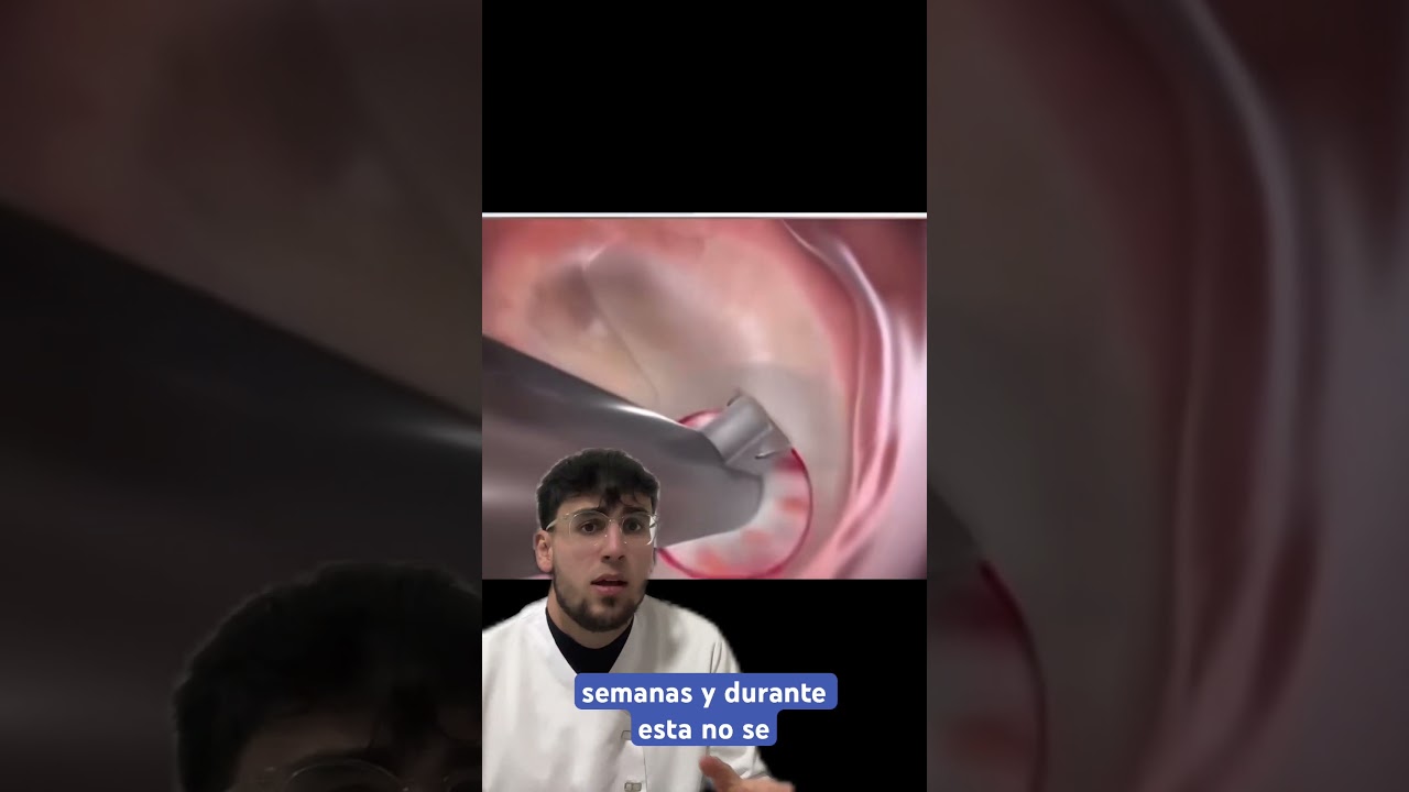 ¿ Como se realiza una tímpanoplastia (operación del tímpano)?