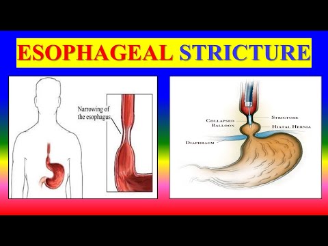 ESOPHAGEAL STRICTURE - meaning , causes , diagnostic , treatment and management