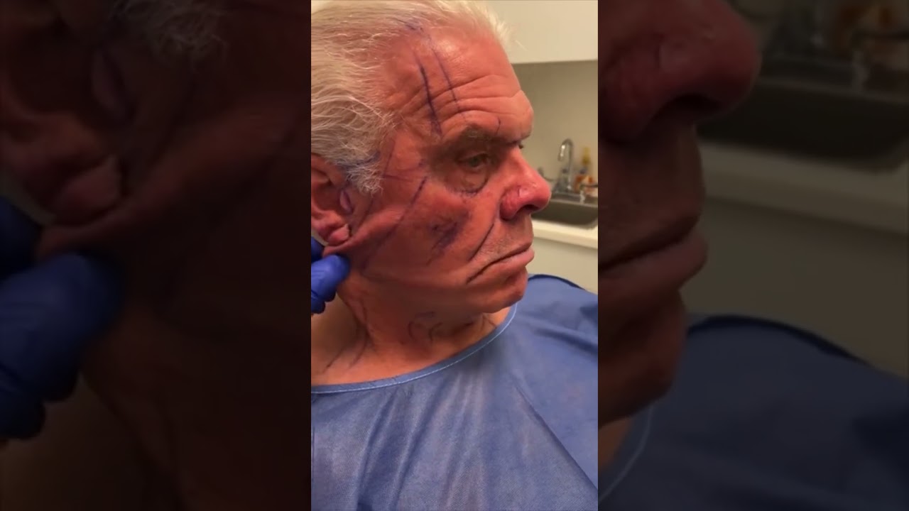 Incredible Male Facelift Transformation! #faceliftnyc #facelift #faceliftbeforeandafter #faceliftnj