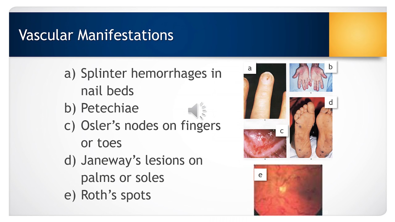 Infective Endocarditis Voice Recorded PowerPoint